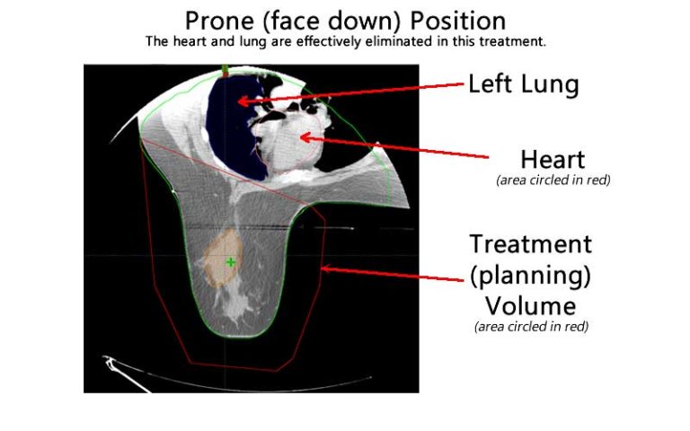 Prone Breast Radiation Therapy • Image Guided Radiation Therapy
