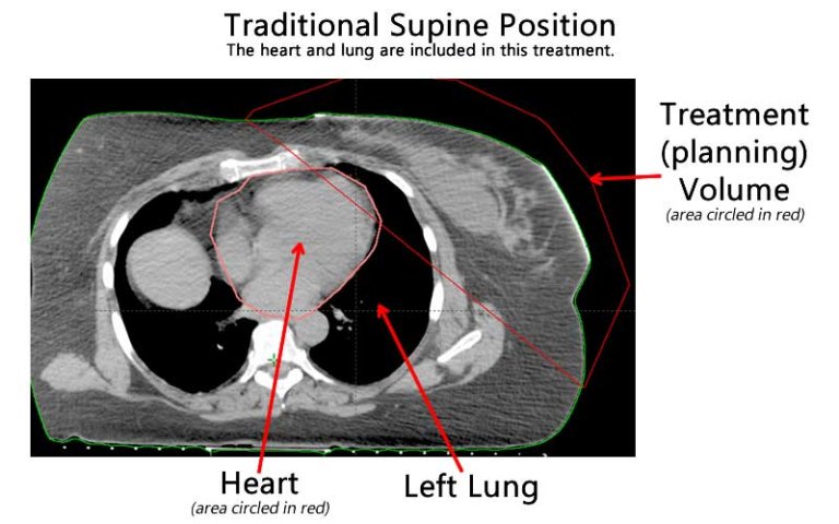 Prone Breast Radiation Therapy • Image Guided Radiation Therapy